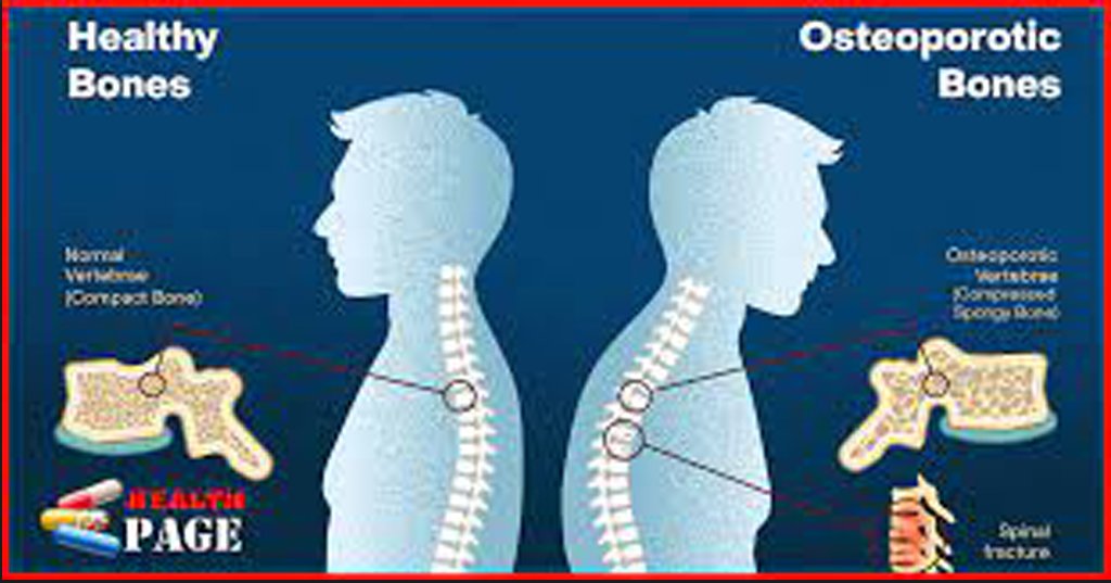 understanding osteoporosis causes symptoms and treatment