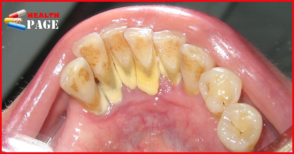 How to remove the yellow tartar on the inside of the teeth?