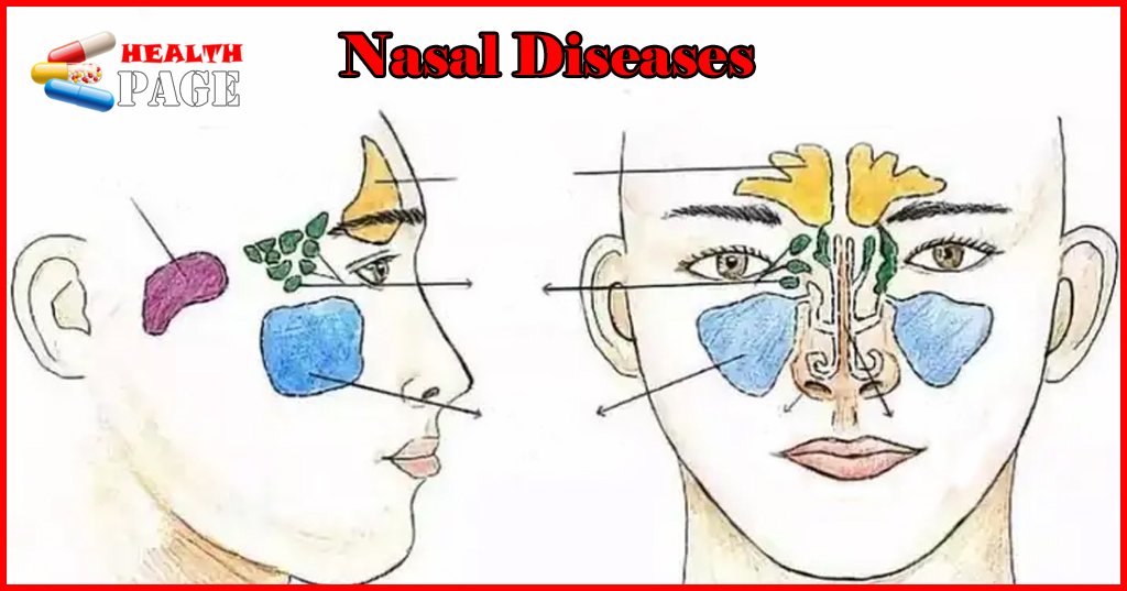 Let's know some major Nasal Diseases