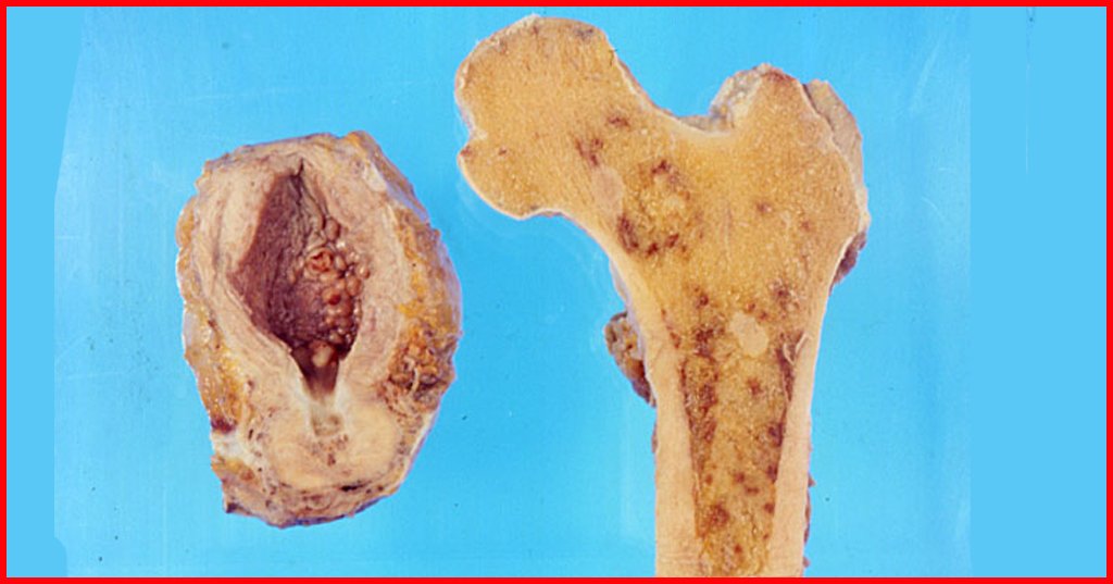 How long can you live with cancer "bone metastasis"?