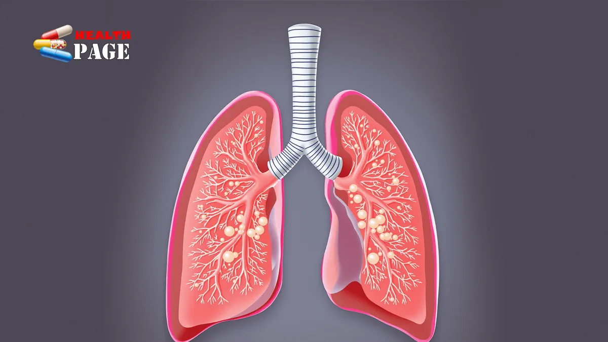 Top 7 Alarming Facts About Pulmonary Edema ICD-10 Codes